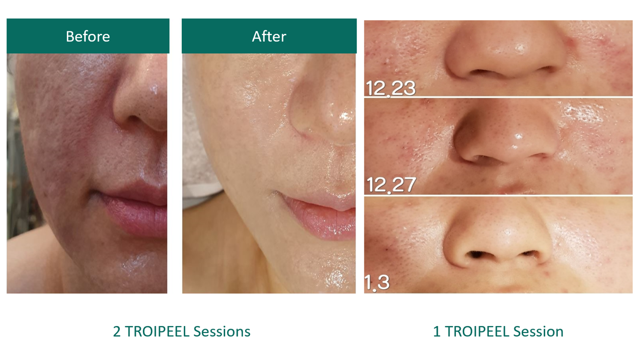 TROIPEEL – Foundation